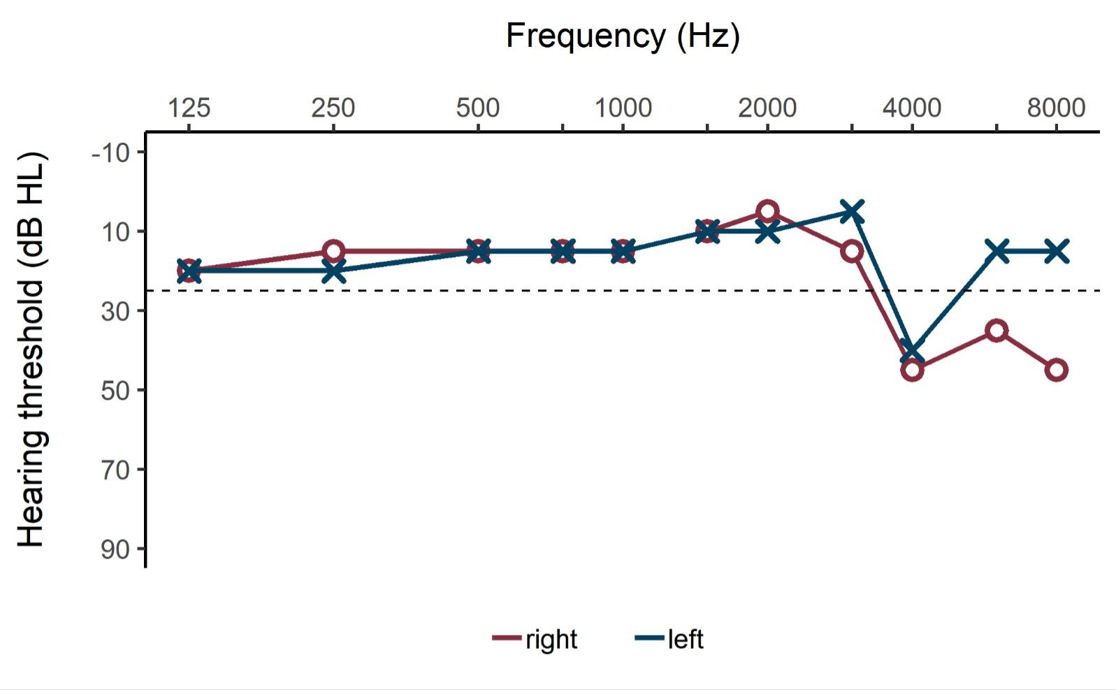 Figure 1: Audiogram
