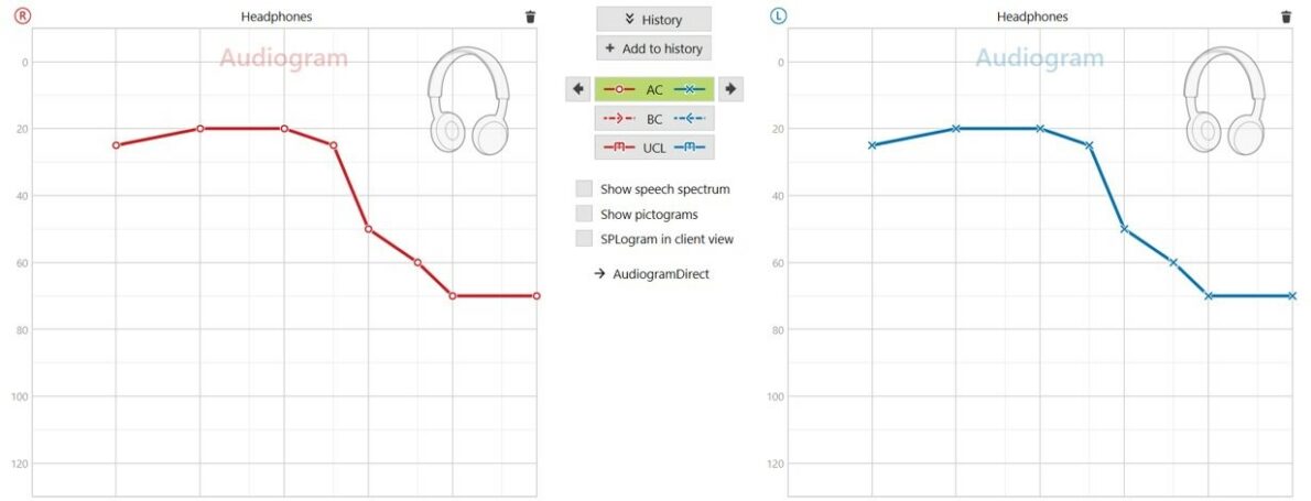 A mild to moderate hearing loss with good low frequency hearing sloping ...