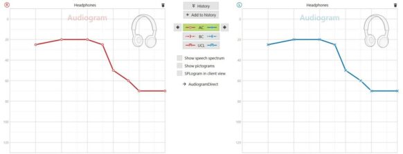 A mild to moderate hearing loss with good low frequency hearing sloping ...